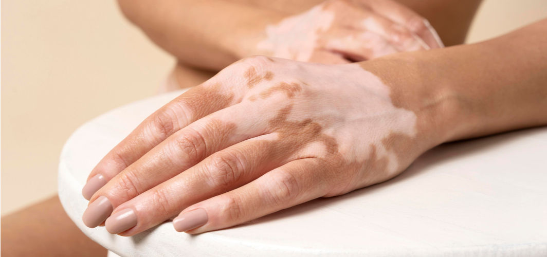 Can The Patchy Loss Of Skin Colour In Vitiligo Be Treated?