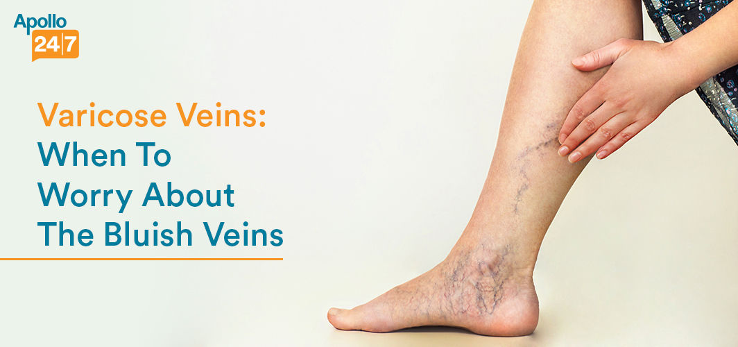 Varicose Veins: When to Worry About the Bluish Veins