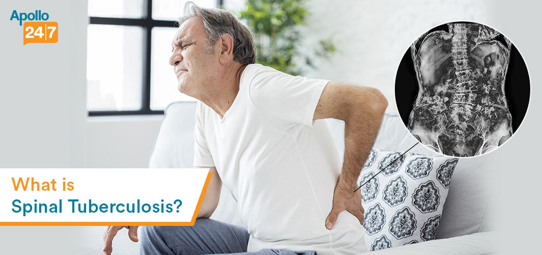 What is Spinal Tuberculosis [TB]?
