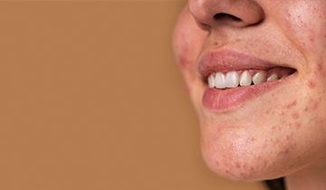 Acne: Causes, Treatment and How to Get Rid of It