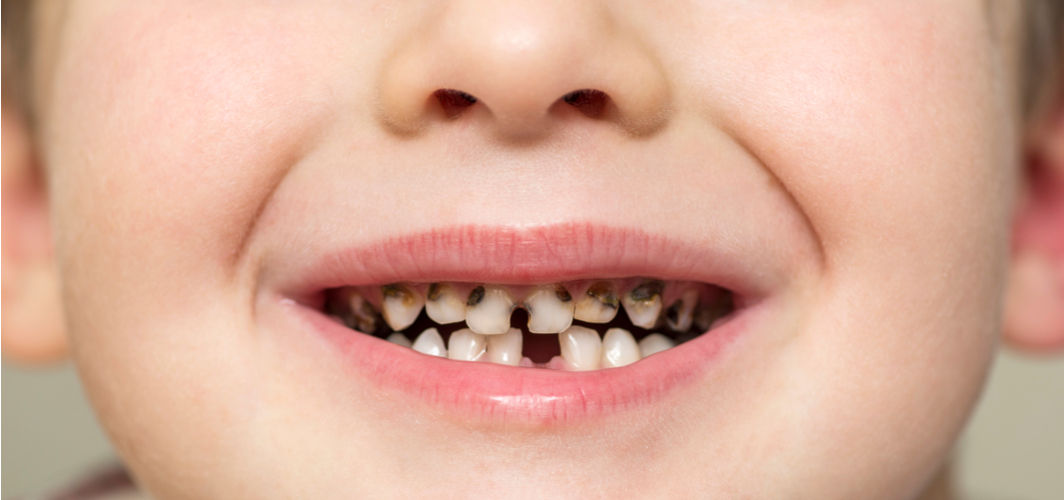 What are nursing bottle caries and how can you prevent them?