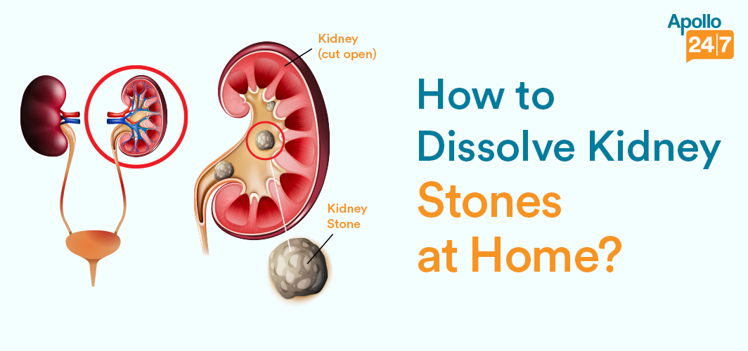 How to Dissolve Kidney Stones at Home?