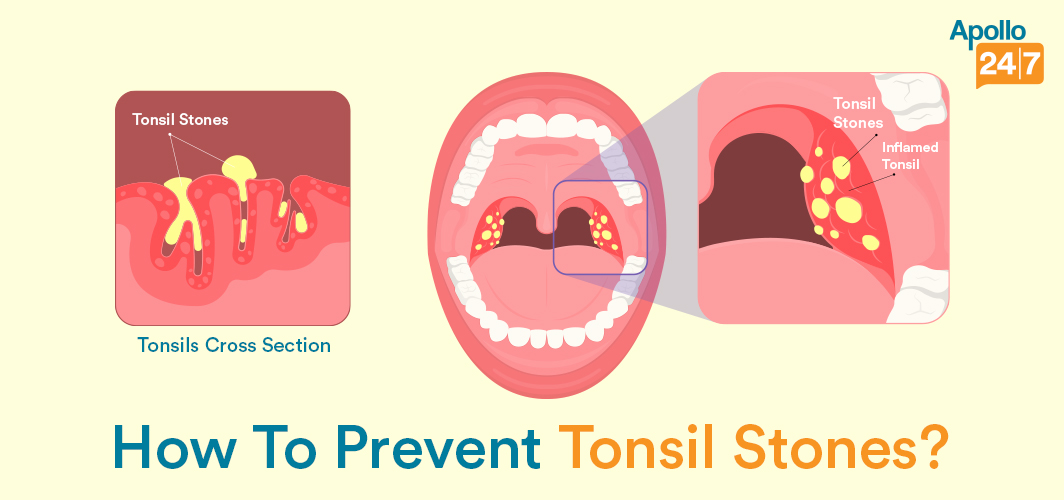 Tonsil Stones and How to Prevent Them?