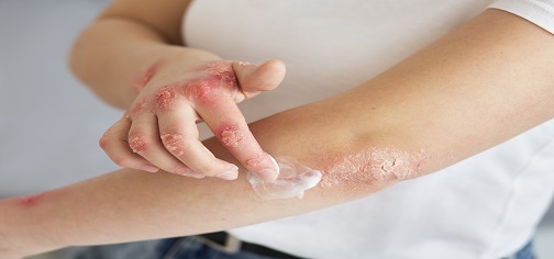 Skin Rashes: Causes, Symptoms, Red Flags and Treatment