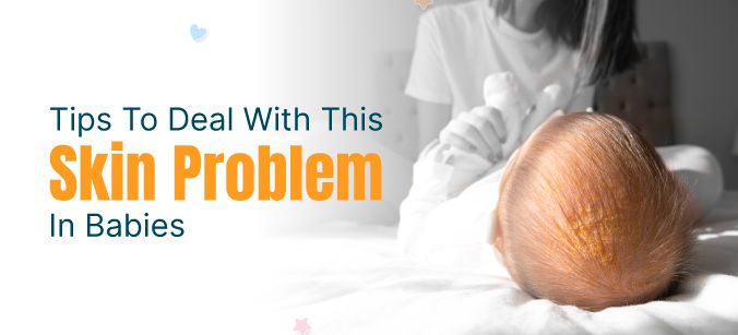 Patchy Scalp Of Babies: Know How To Deal With It