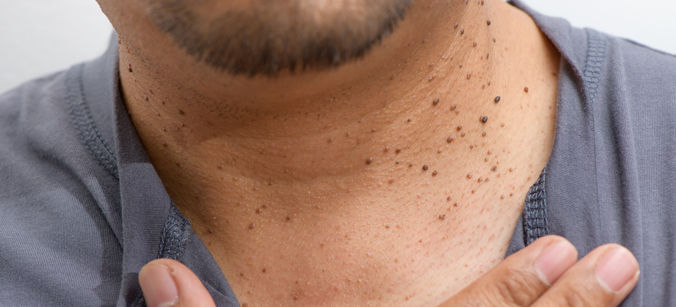 Warts-View Causes, Symptoms and Treatments | Apollo247