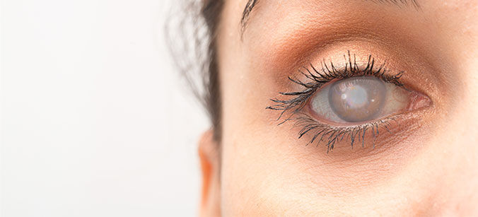 Cataract -View Causes, Symptoms and Treatments | Apollo247