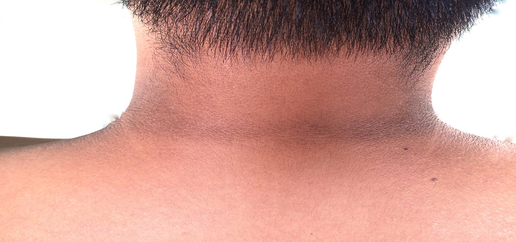 Why Is My Neck Turning Black?