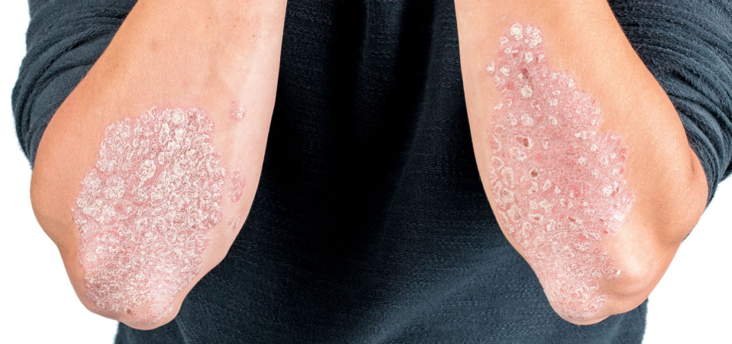 Yes, it is possible to manage Psoriasis! Follow these strategies & don ...