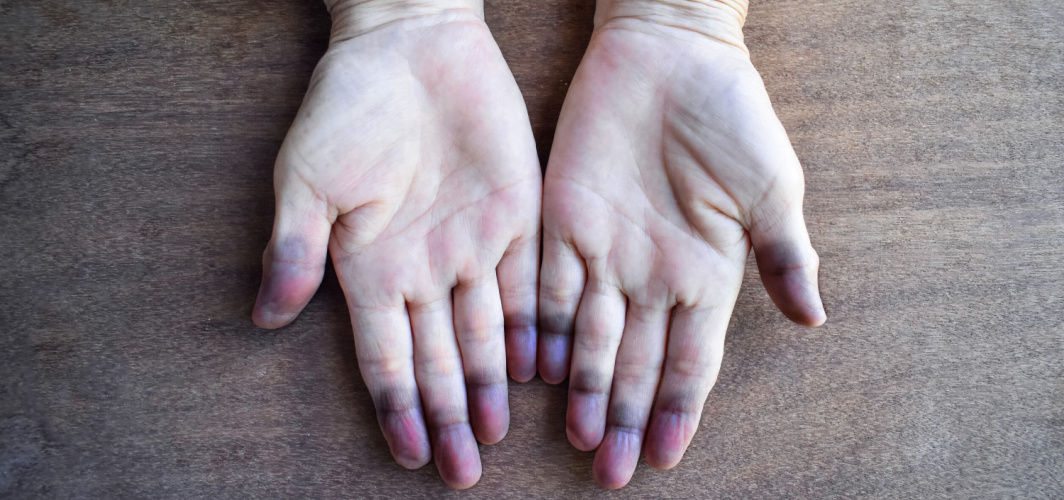 Heart disease - 7 warning signs that occur on your skin