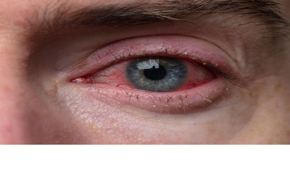 9 FAQs About Conjunctivitis
