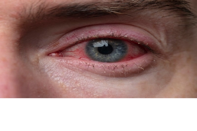 9 FAQs About Conjunctivitis