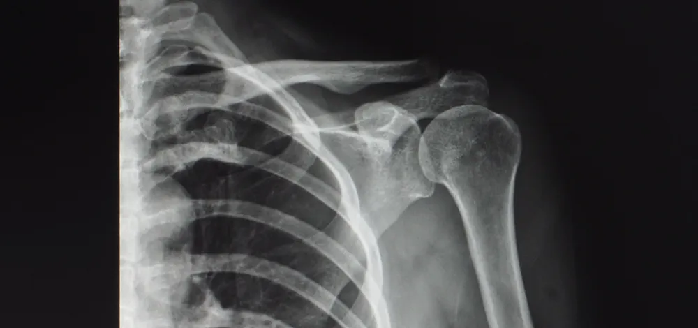 shoulder scope surgery time