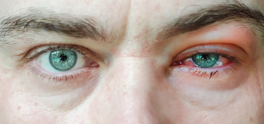 4 Warning Signs of Conjunctivitis: Know When To Consult A Doctor