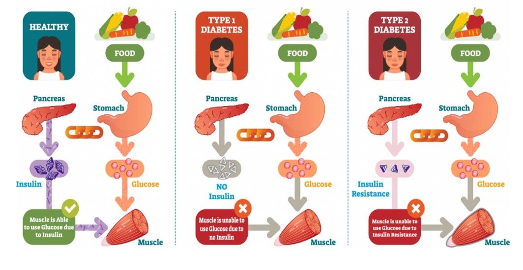 Exploring The Different Types Of Diabetes