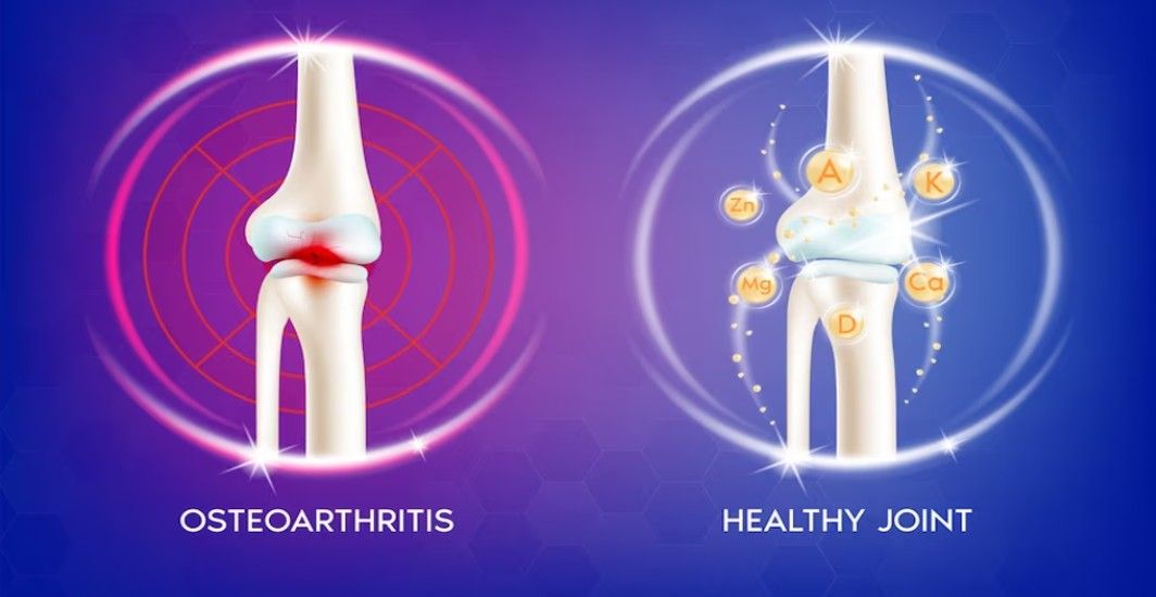 Diabetes And Osteoarthritis: Navigating Joint Health