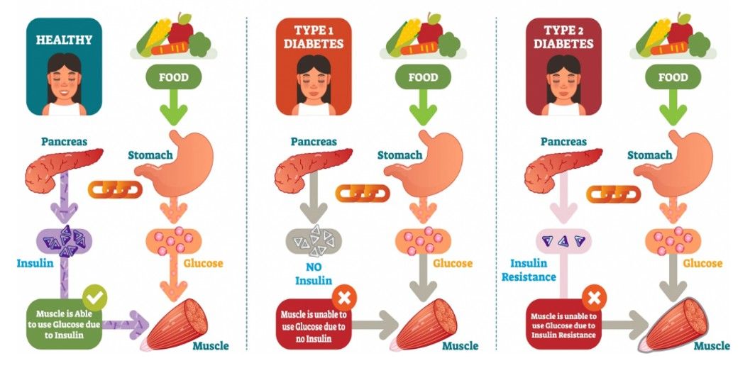 Difference Between The Types Of Diabetes