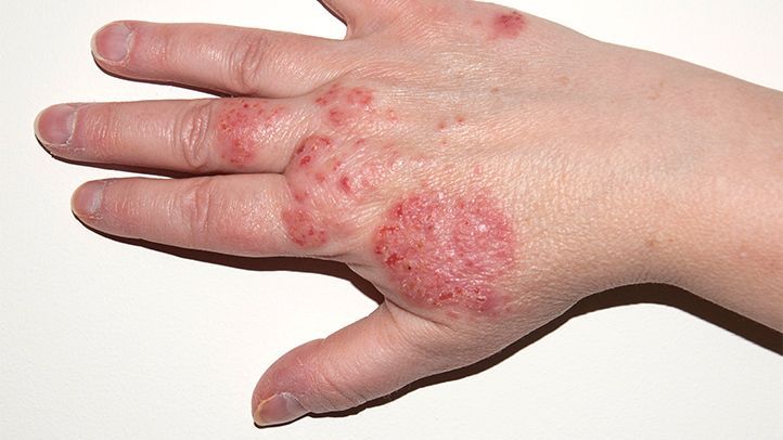 Eczema -Overview Causes, Symptoms, and Risk factors | Apollo247