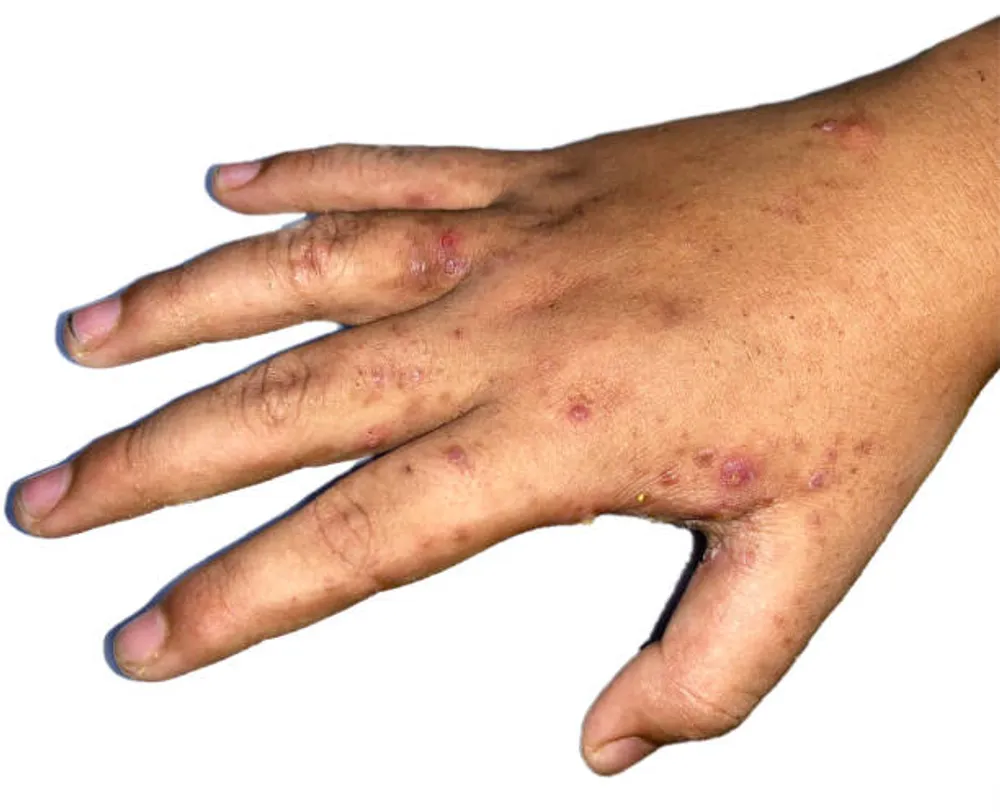 scabies burrows