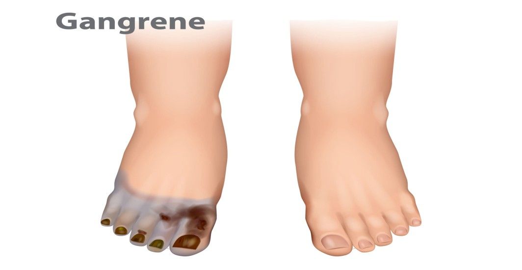 Can Diabetes Cause Gangrene?