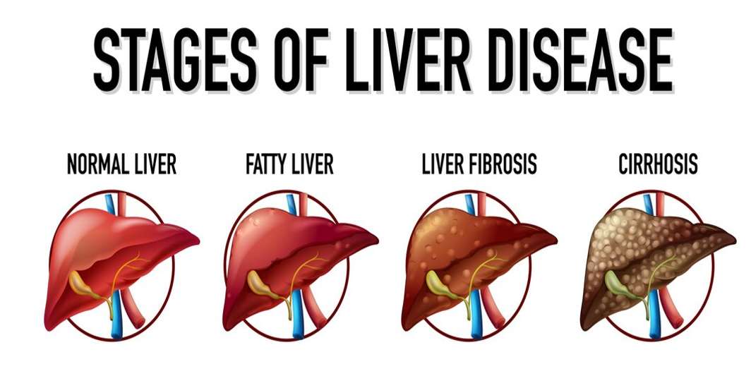 Understanding Different Types of Fatty Liver Disease
