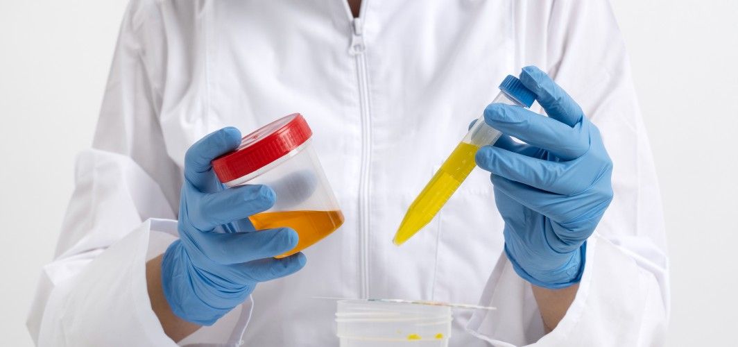 Urea Normal Range: Normal Range, Procedure, and Results