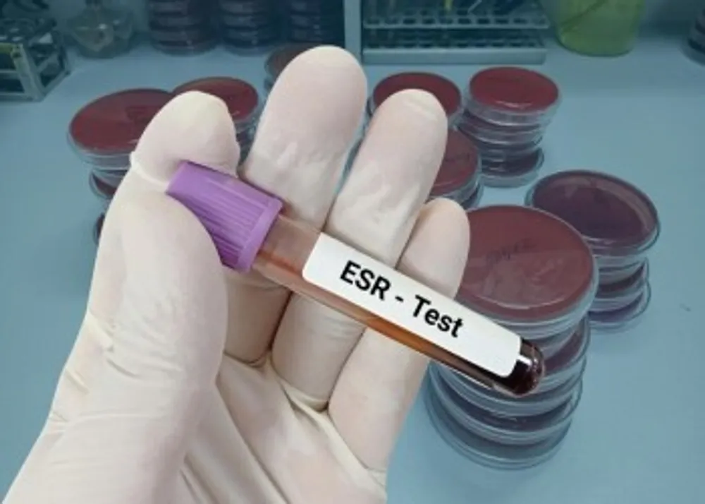 temporal arteritis esr range