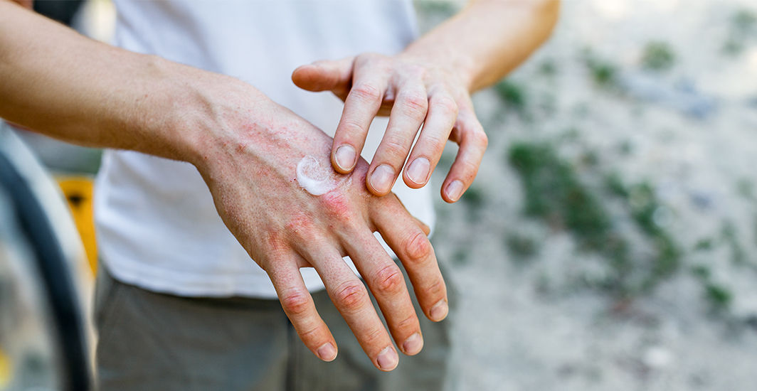 Soframycin Cream: How Does It Help Treat Skin Infections?