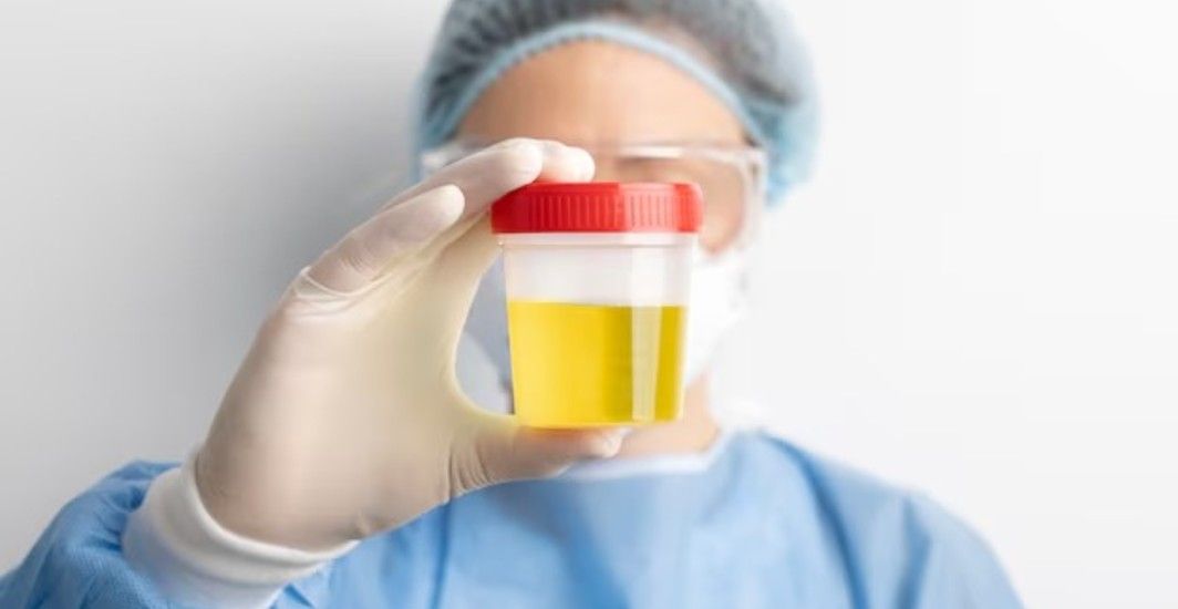 Epithelial Cells in Urine: Normal Range, Causes & Health Risks
