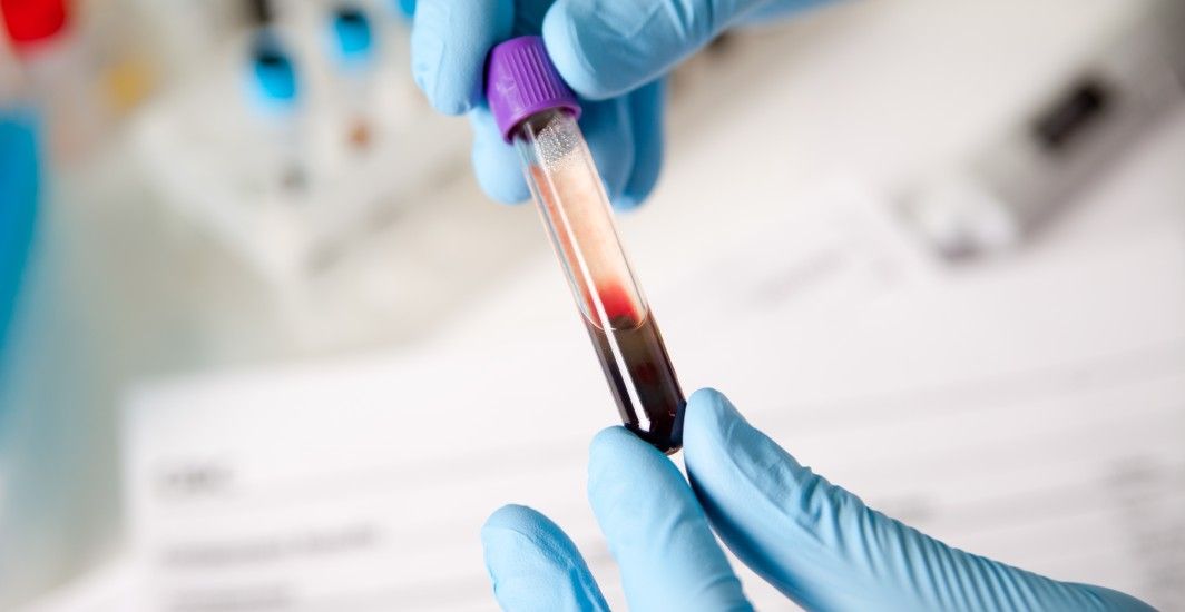 DLC Test – Normal Range, Purpose, Procedure, and Results Interpretation