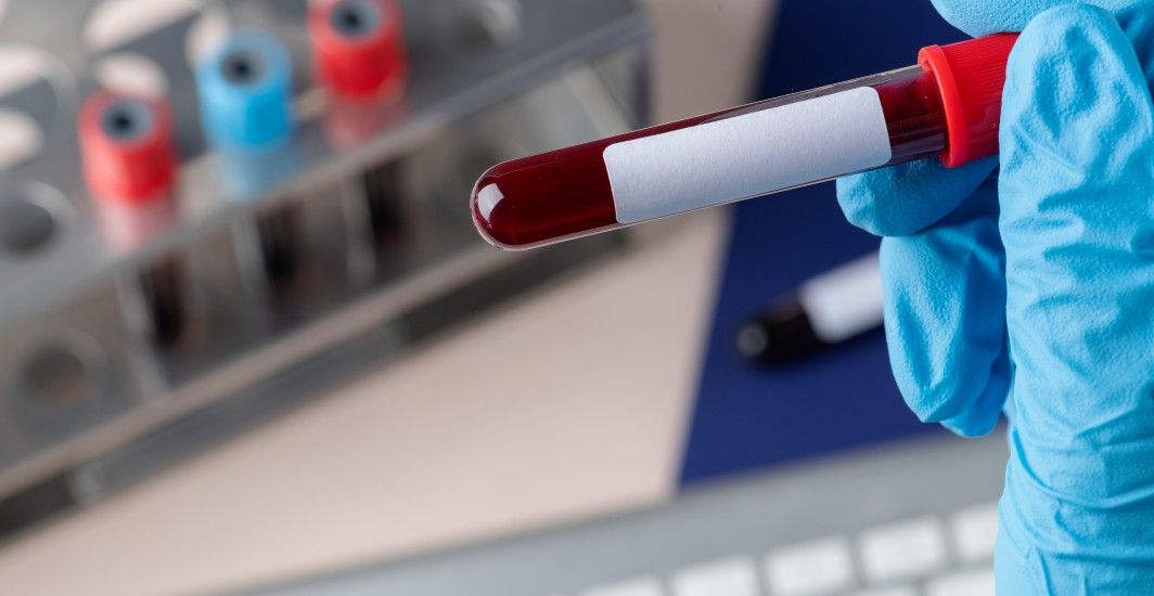 Aspartate Aminotransferase (AST/SGOT), Serum Test - Normal Range ...