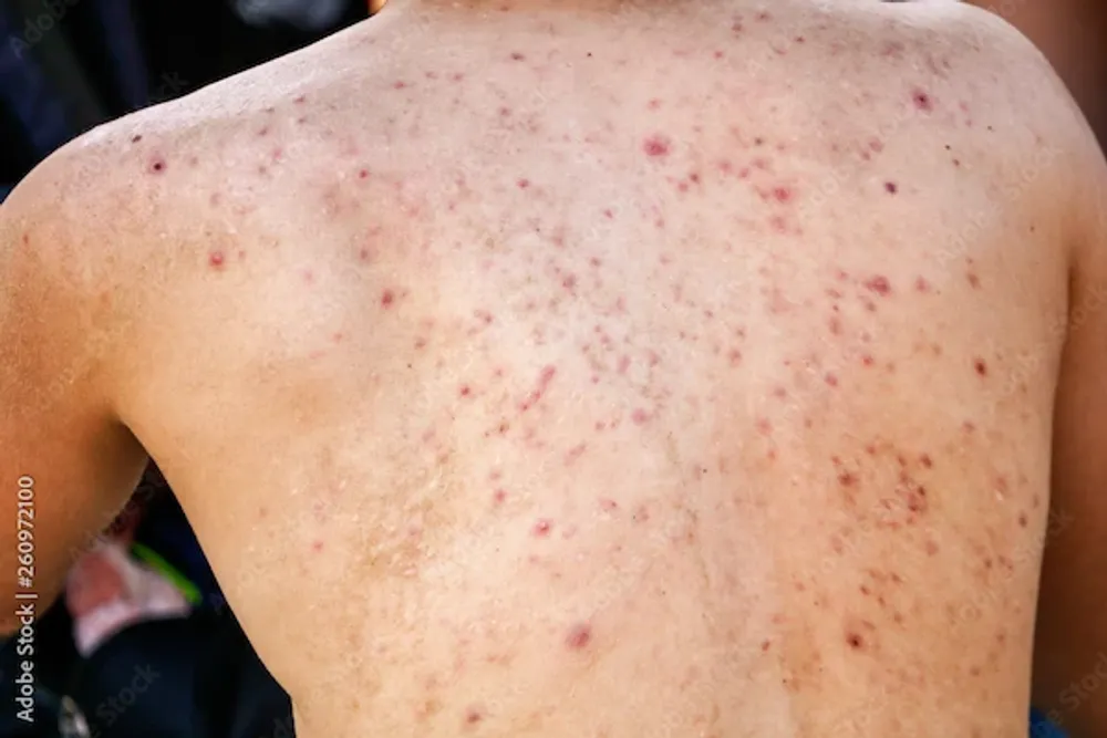 severe spots on back