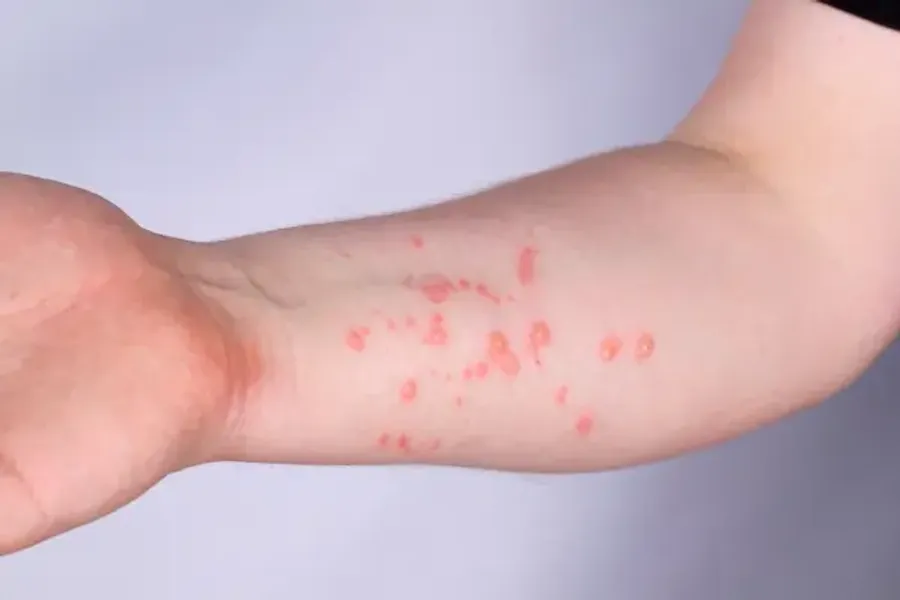 Managing Scars from Monkeypox