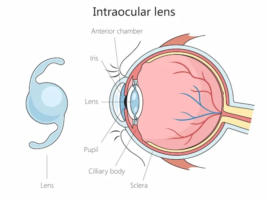 Intraocular Implants After Cataract Surgery