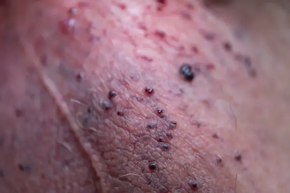 pimples on testicles cure