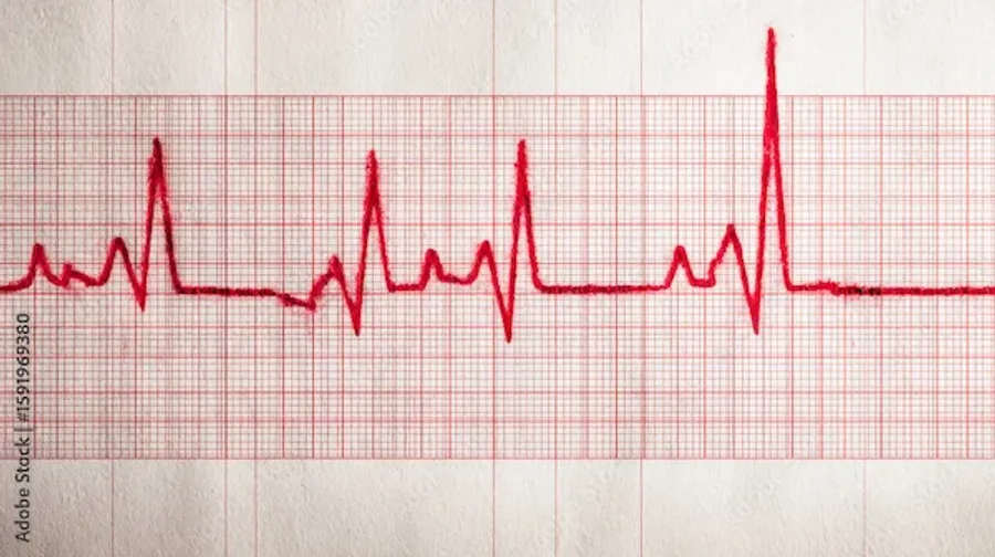 Causes of Atrial Fibrillation Explained