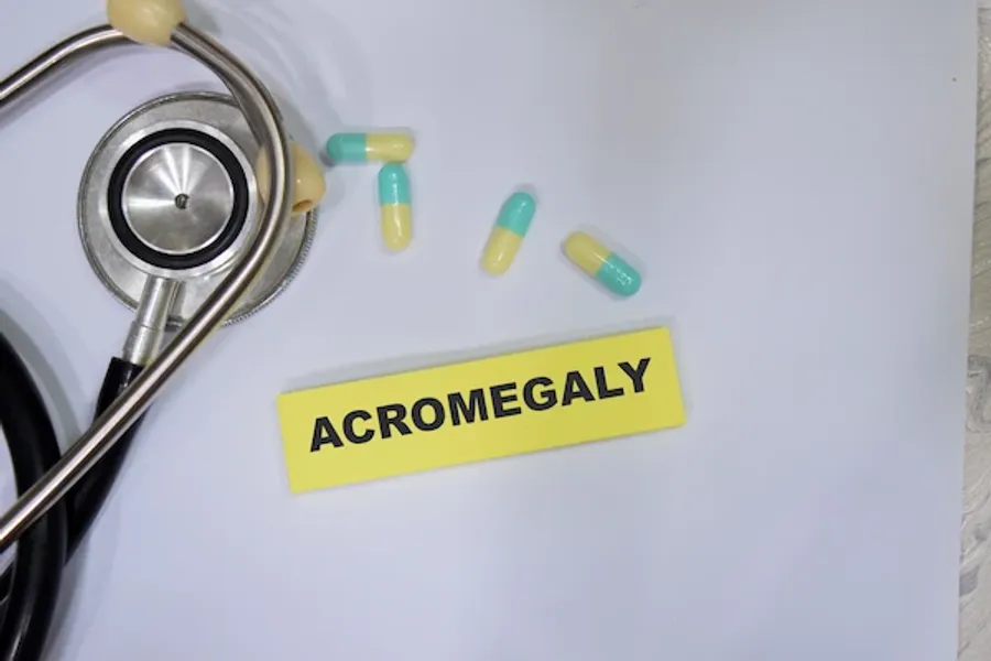 Acromegaly and Gigantism Comparison