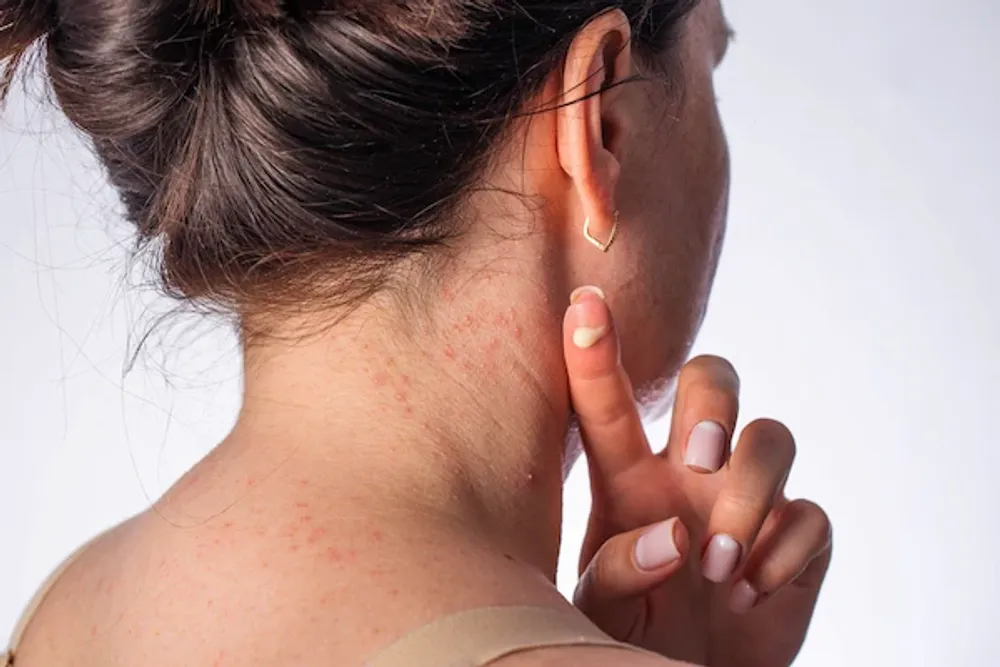 fungal skin infections