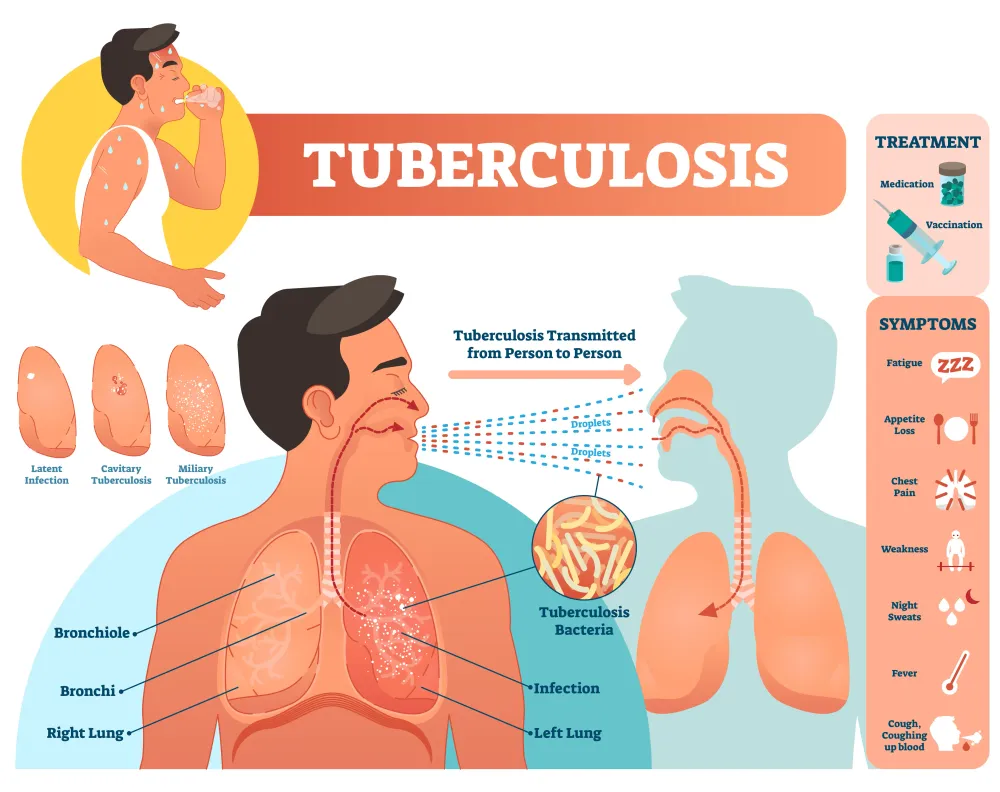 tuberculosis lungs thyroid