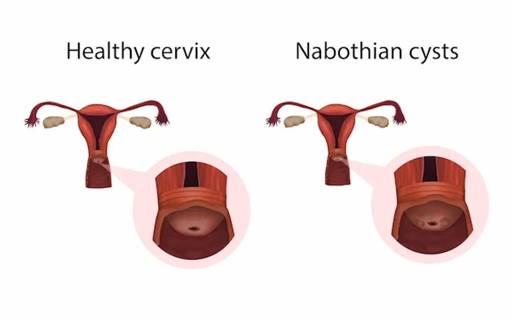 cervical cyst types