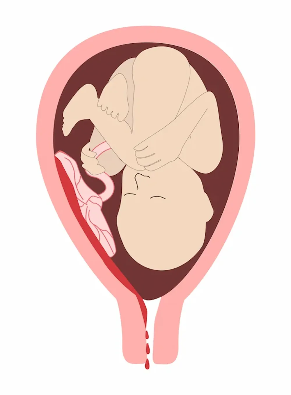 placenta abruption