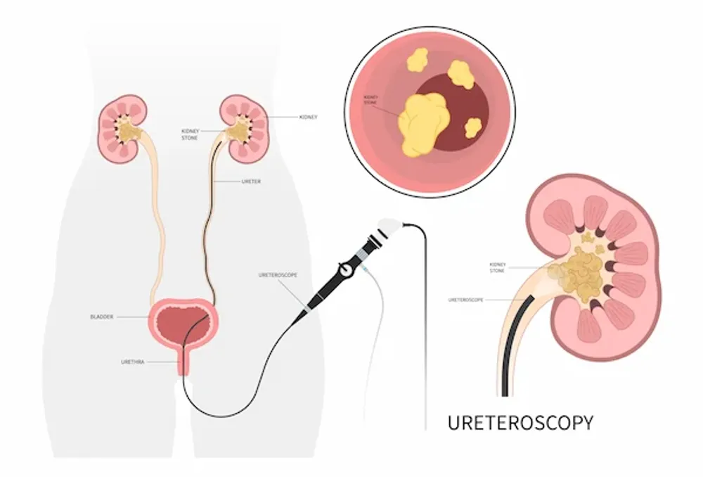 ureteric