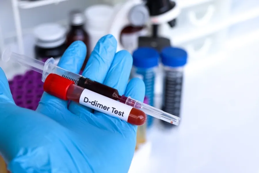 D-Dimer Test and Its Role in Blood Clots