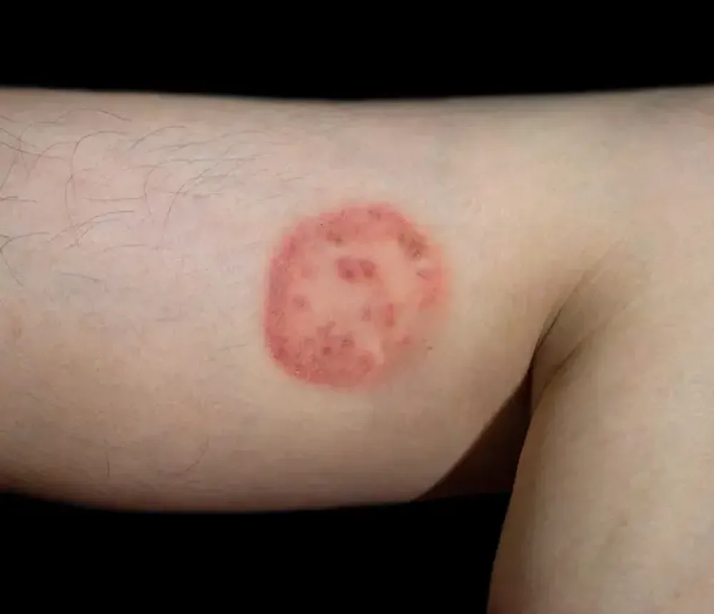 severe ringworm symptoms