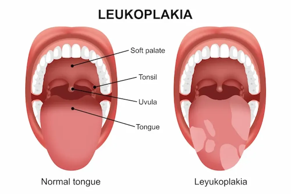 tonsillar leukoplakia