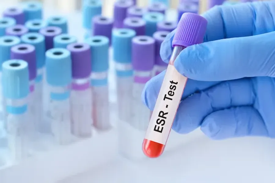 ESR Test Overview and Interpretation