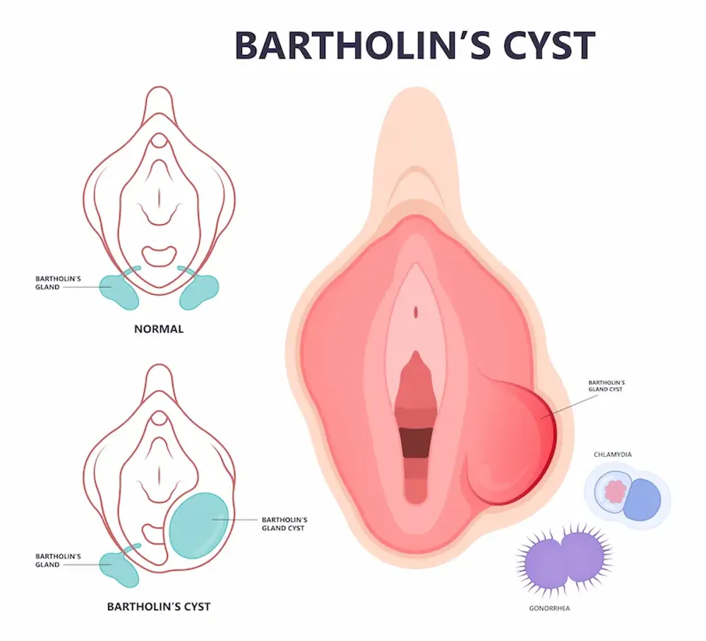 bartholinitis causes