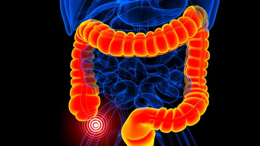 Understanding Appendicitis Signs and Treatment Options