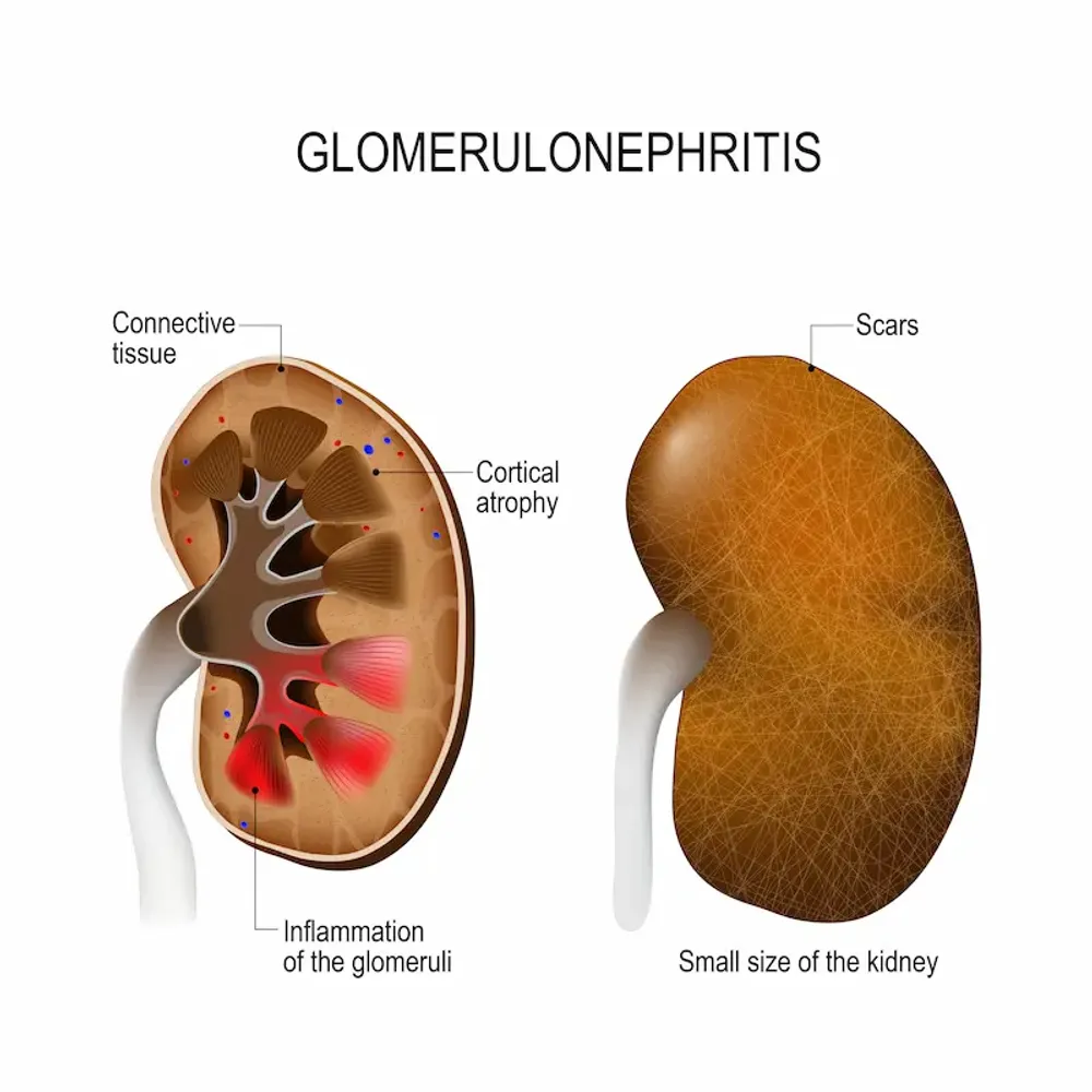glomerulonephritis kidney function