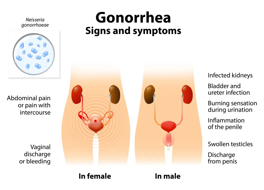 rectal gonorrhea test